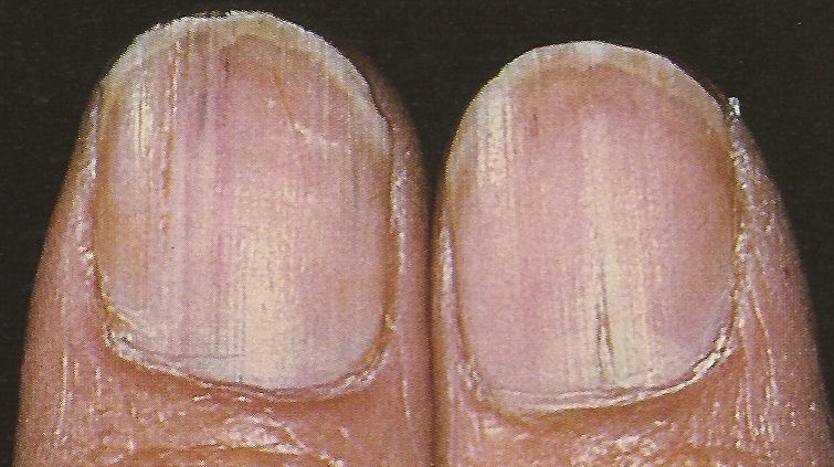What your nails say about your health